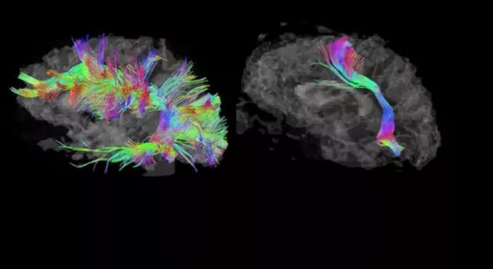 El cerebro Asperger y su diferencia con el neuro-típico