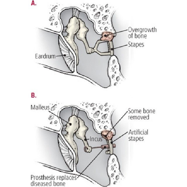 Understanding Otosclerosis
