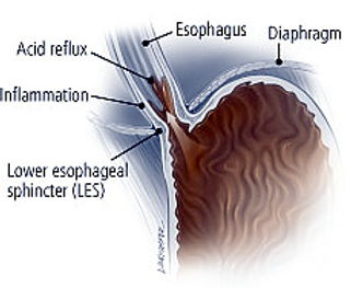 How does OSA cause GERD?