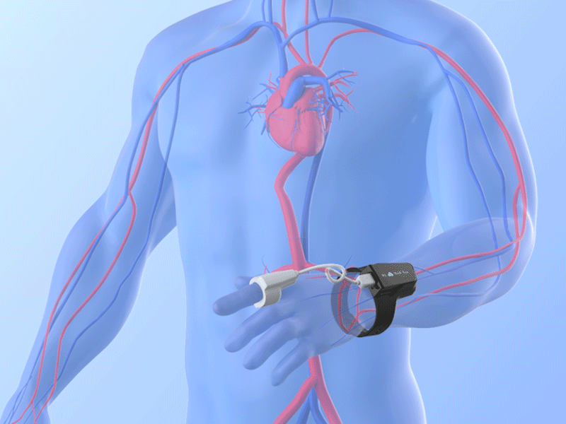 How PPG Technology Reforms Sleep Studies and Aids in Sleep Apnea Diagnosis