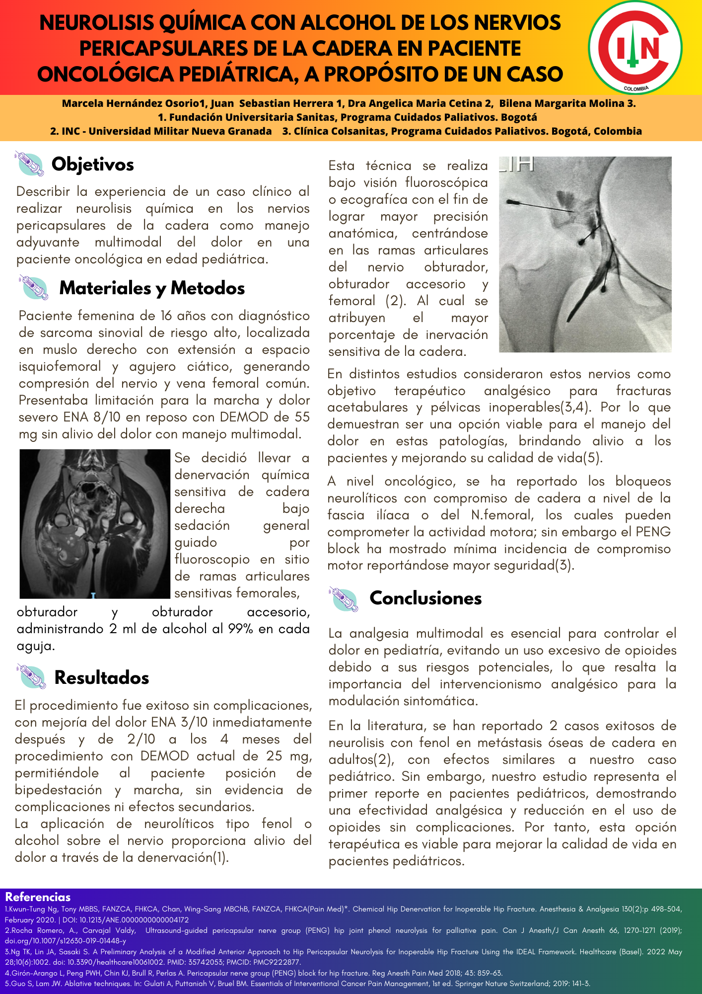 Neurolisis química con alcohol de los nervios pericapsulares de la ...