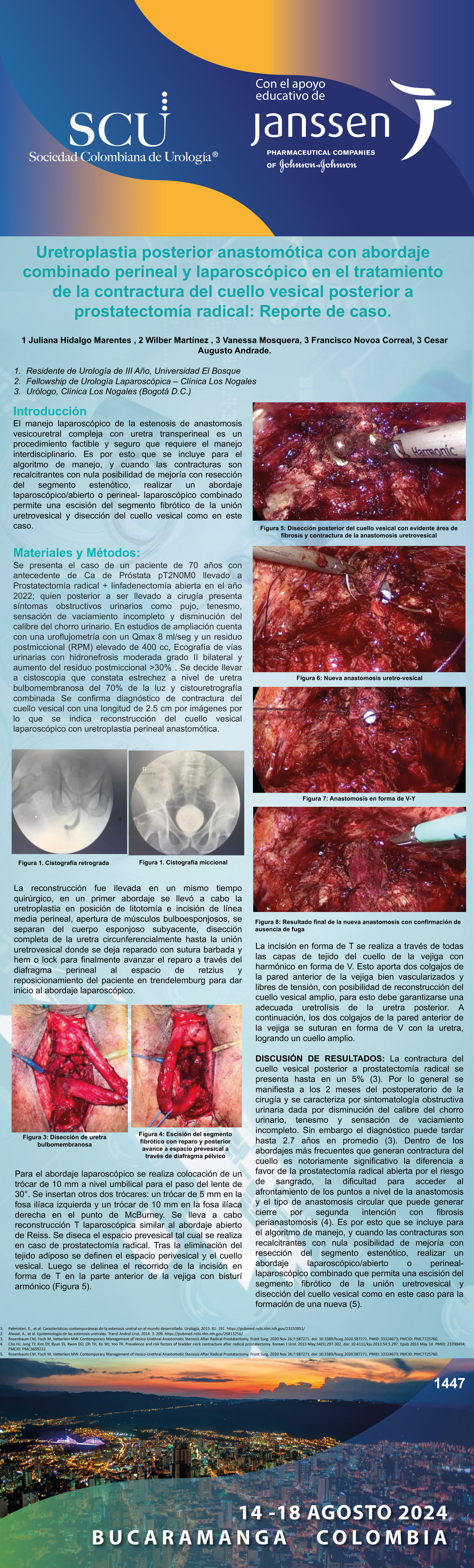 Uretroplastia posterior anastomótica con abordaje combinado perineal y ...