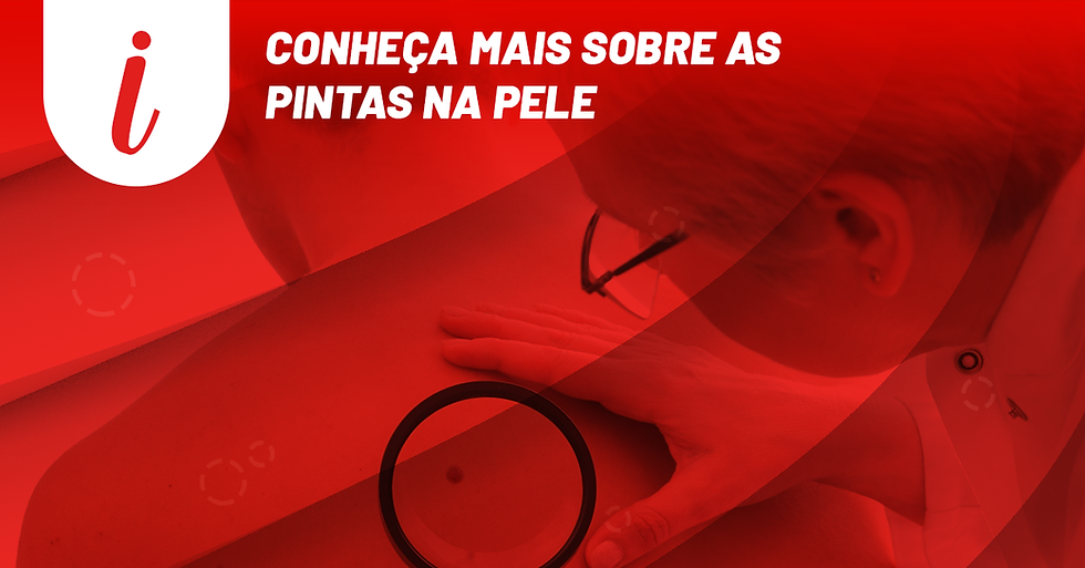 Conheça mais sobre as pintas na pele