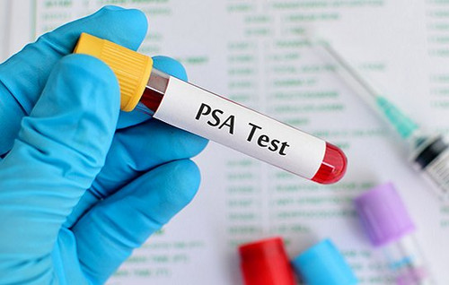 PSA TOTALE + PSA FREE | villa-gioia