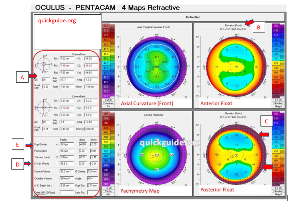 Guide to Pentacam maps