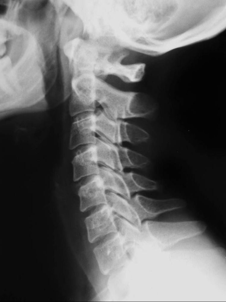 TODO SOBRE UN LATIGAZO CERVICAL