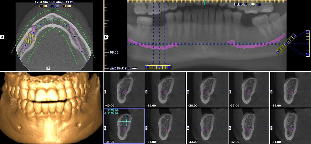 The role of CBCT in dental implant