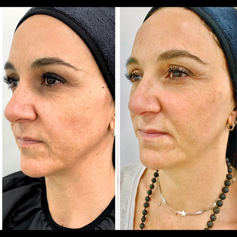 Sculptra | Clinica Avaria