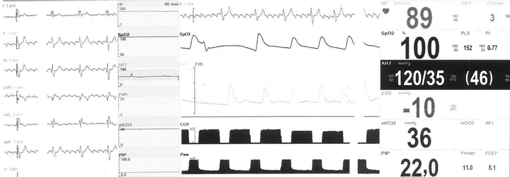 The "sawtooth" arrhythmia