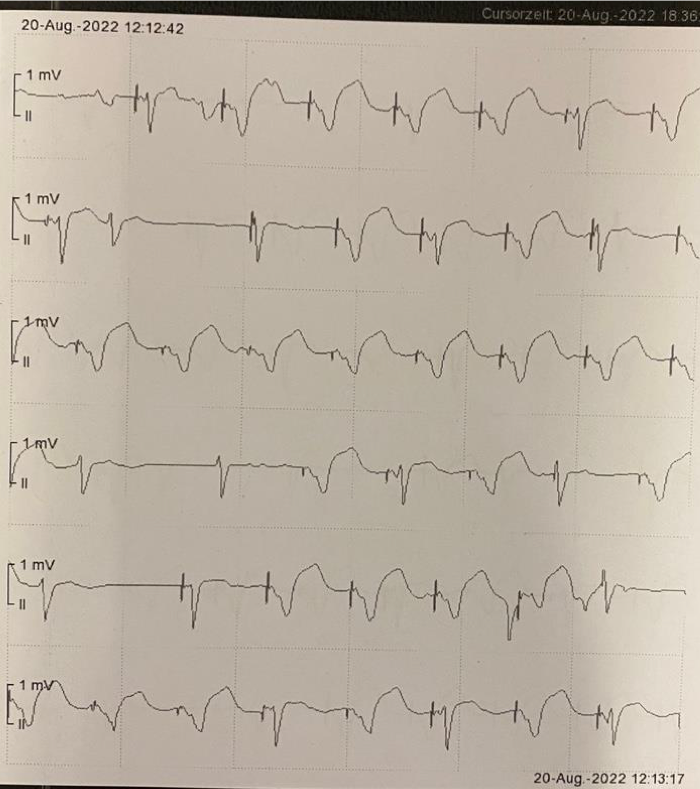EKG | Pediatric Arrhythmias