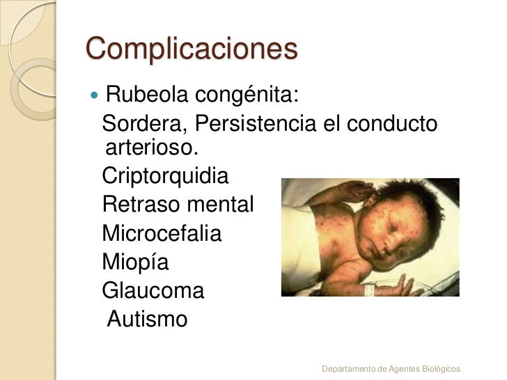 Síndrome de rubéola congénita...