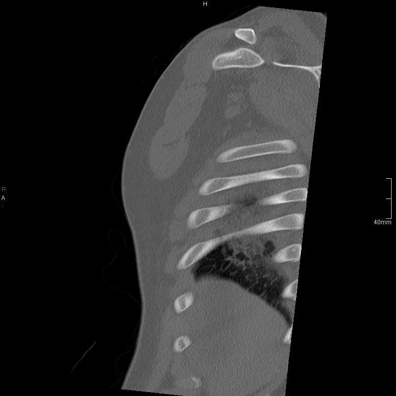 CT HUMERUS CONTRAST & NON CON | Rad CT Guide