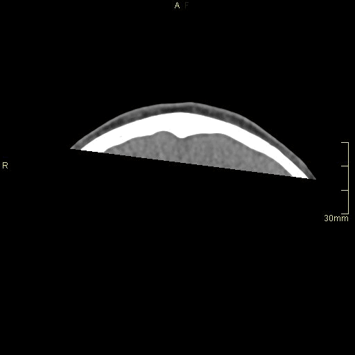 Ct Orbits Non Contrast Rad Ct Guide