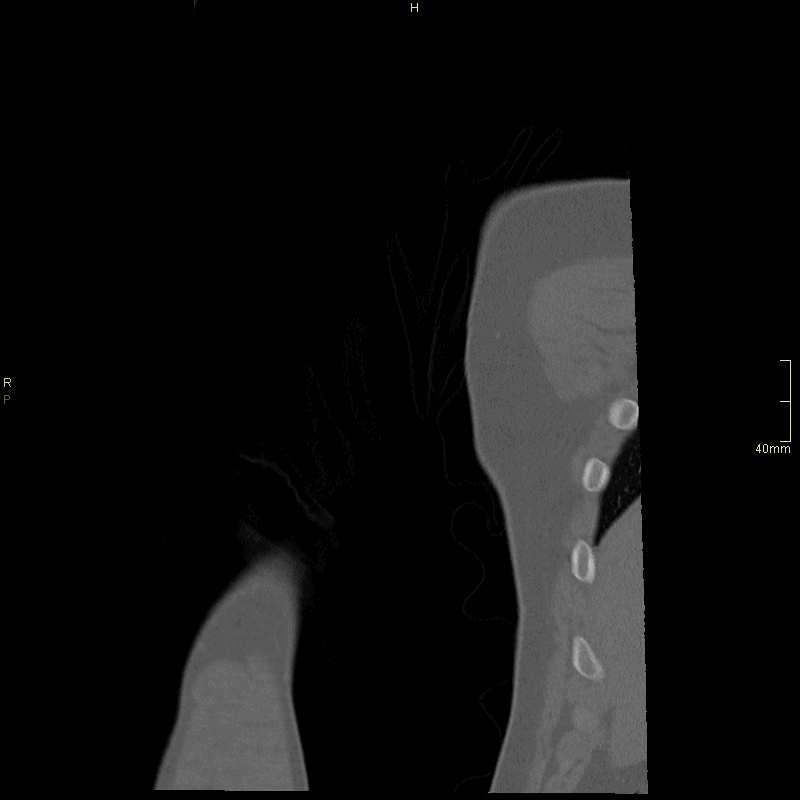 CT HUMERUS CONTRAST & NON CON | Rad CT Guide