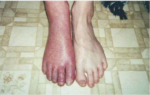 SÍNDROME DE SUDECK: DSR o SRDC