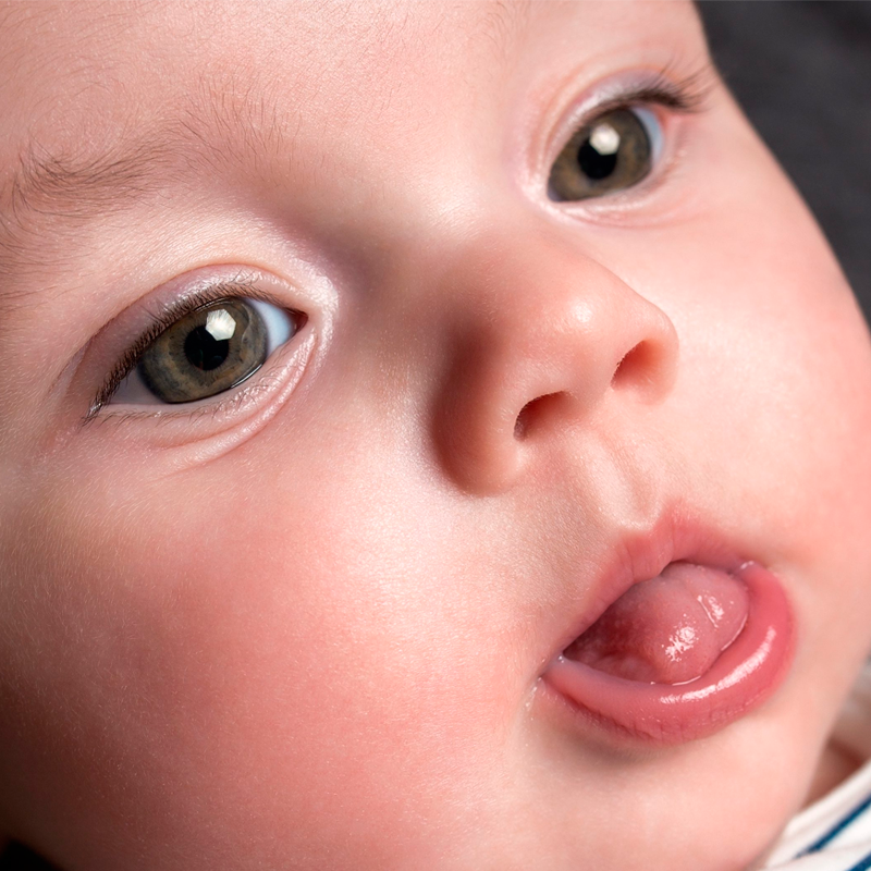 Macroglossia: o crescimento anormal da língua