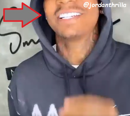 Rapper Moneybagg Yo Gets His Teeth Fixed in Colombia with Veneers For a ...