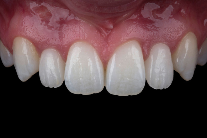 Fixed Finals | Absolute Dental Lab