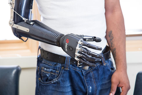 Upper Limb Prosthetics | Handspring