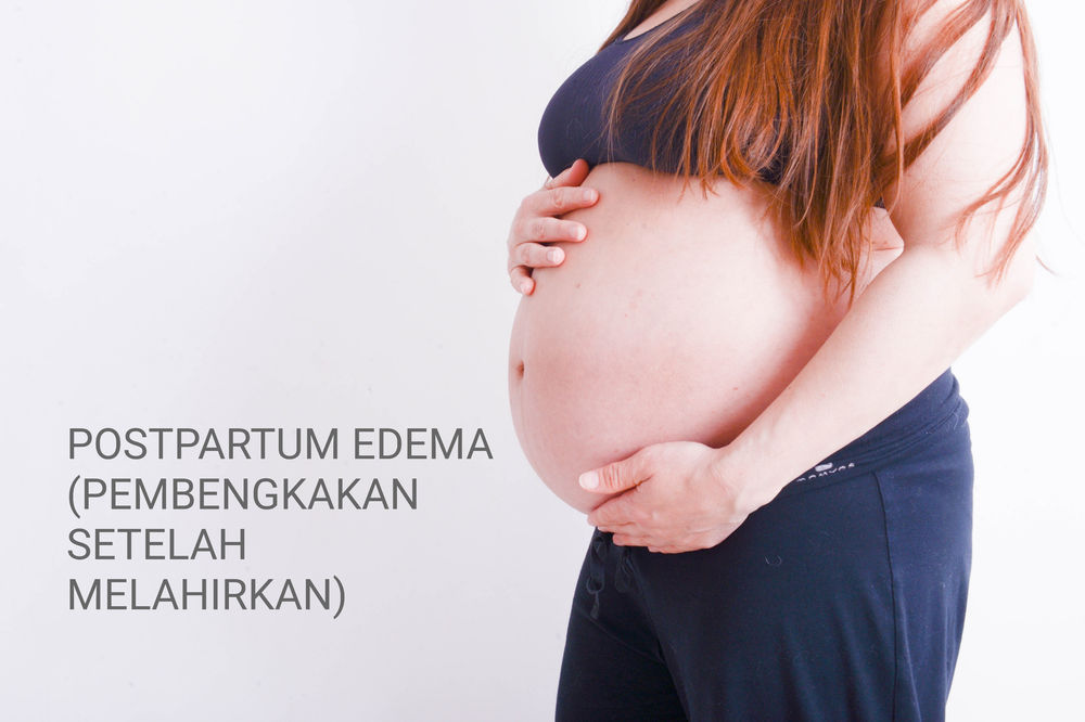 Pembengkakan Setelah Melahirkan (Postpartum Edema), Berbahaya atau Tidak?