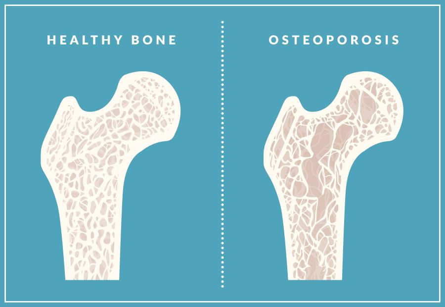 How to Maintain Good Bone Health