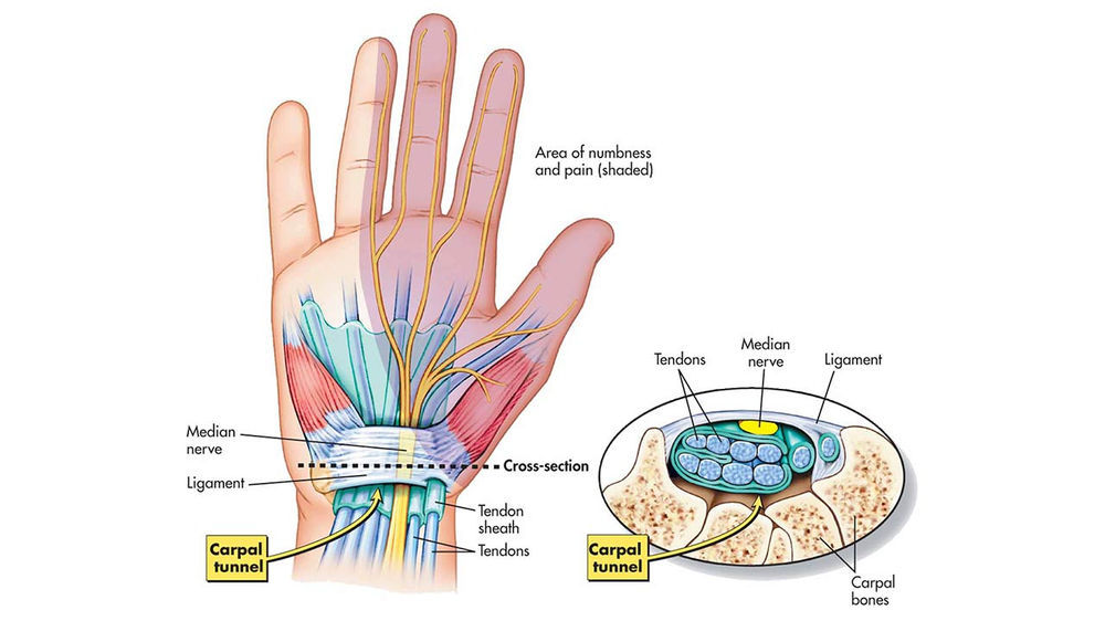 Do I Have Carpal Tunnel Syndrome?