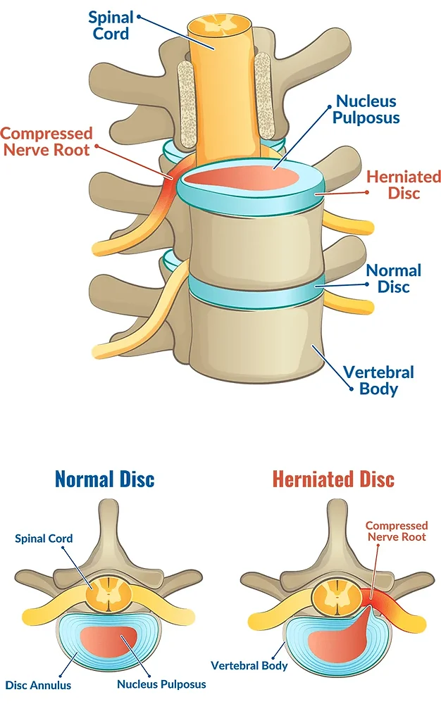 What You Need To Know About Bulging Discs
