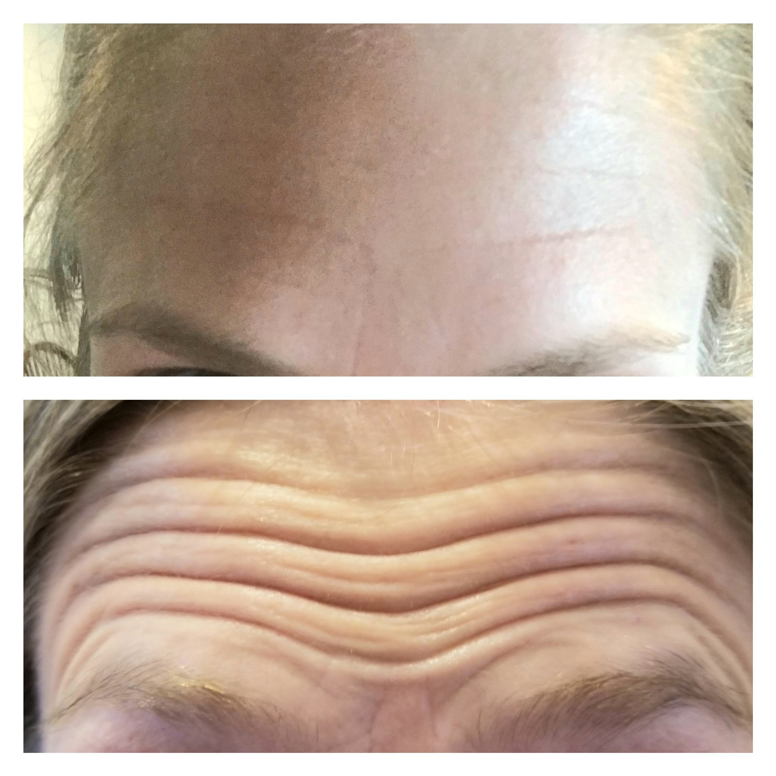 Best Botox® Injections Denver | keep-MD Aesthetic Physician MedSpa ...