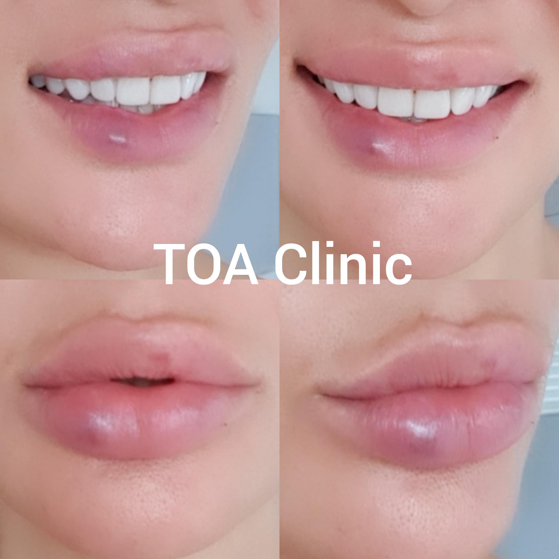 London Botox | TOA Clinic | Lip Filler | PDO Thread Lift | Thermage