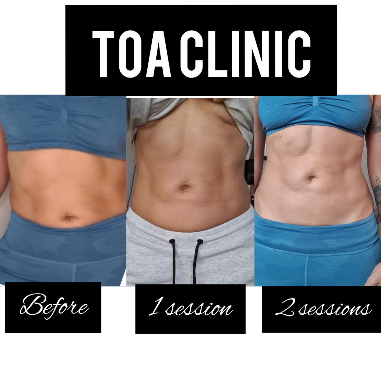 Tesla Sculpt 4 session package | TOA CLINIC