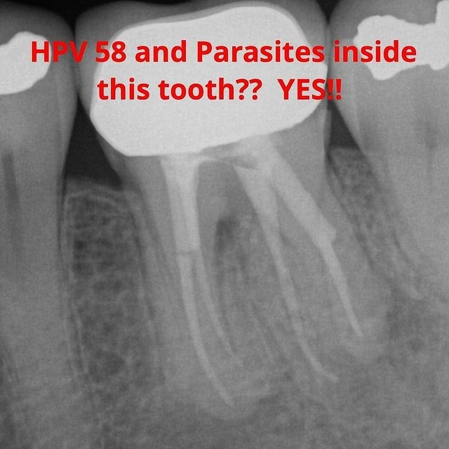 Can HPV and Parasites Hide in Your Dead Teeth?