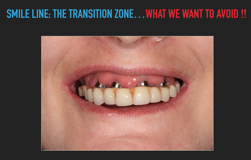 To FP1 or to FP3 , that is the question..PART 1