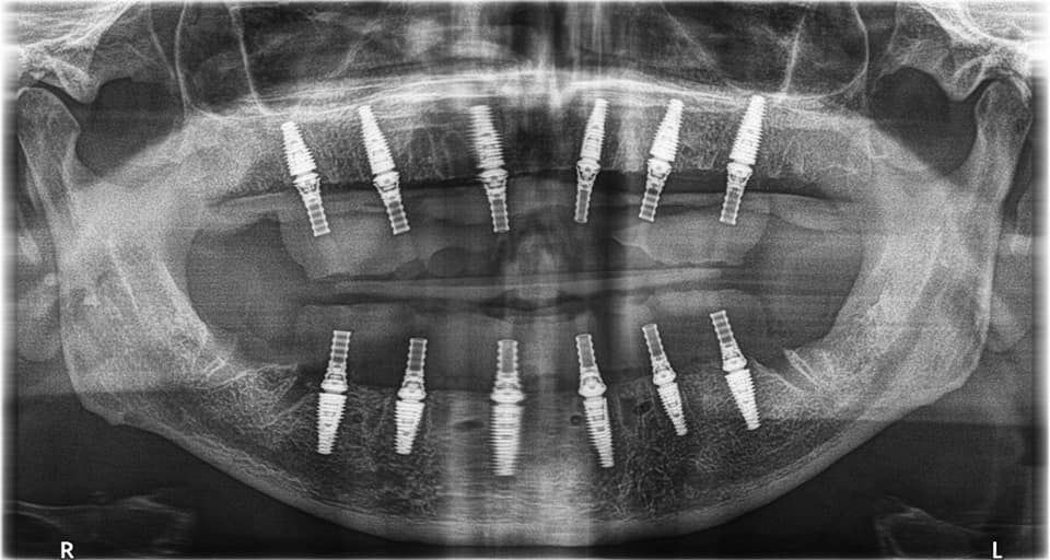 To FP1 or to FP3 , that is the question..PART 2
