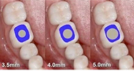 Mastering the Emergence Profile Part 1