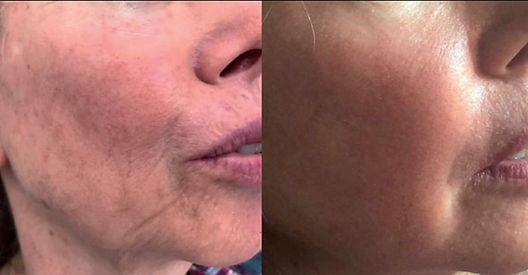 NEOFOUND - Skin Booster | ESTHE.lab