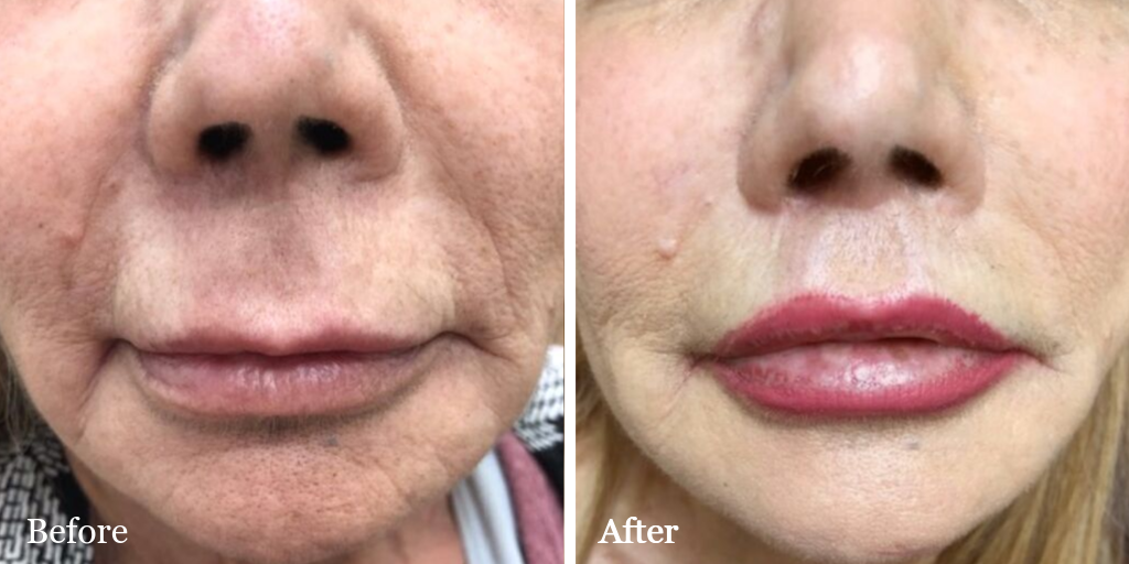 Lip Lifts 101