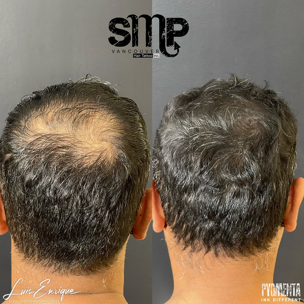 looking for hair loss solutions? SMP can get the job done.