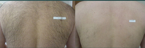 Upper Body Laser Hair Removal - Buy 8, get 20% OFF | Skin Inparlour