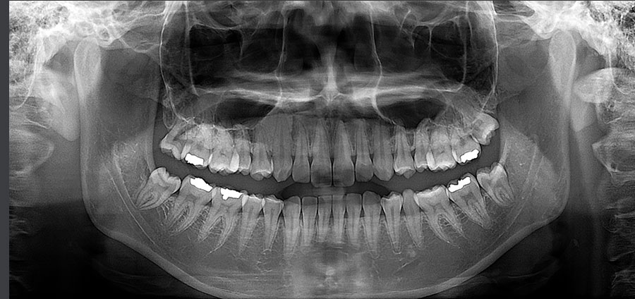 3D Cone Beam | Computer Tomography in Chicago | Archer Dental