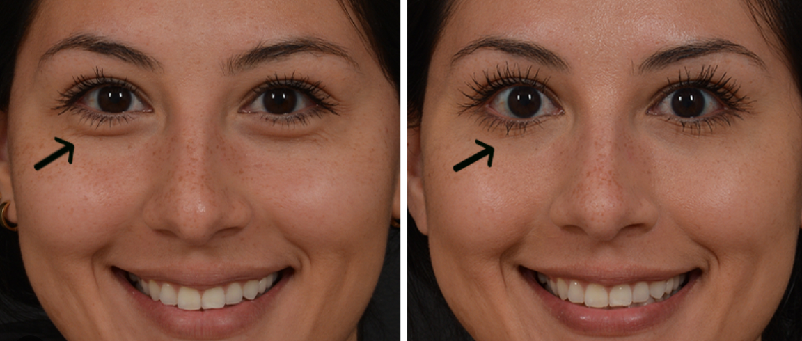 7 Things to Know Before Getting Botox Under Eyes