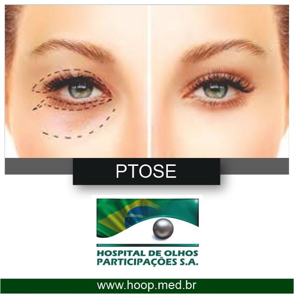 O que é Ptose?