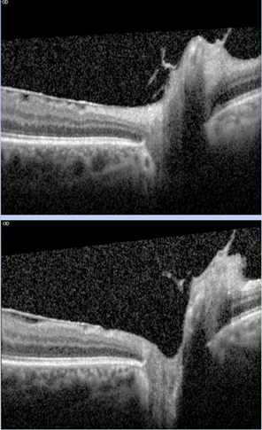 OCTcases | Neuro-Ophthalmology Case 21