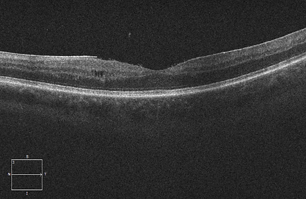 OCTcases | Retina Case 2