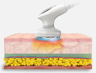 Lipo Zero | arummedi