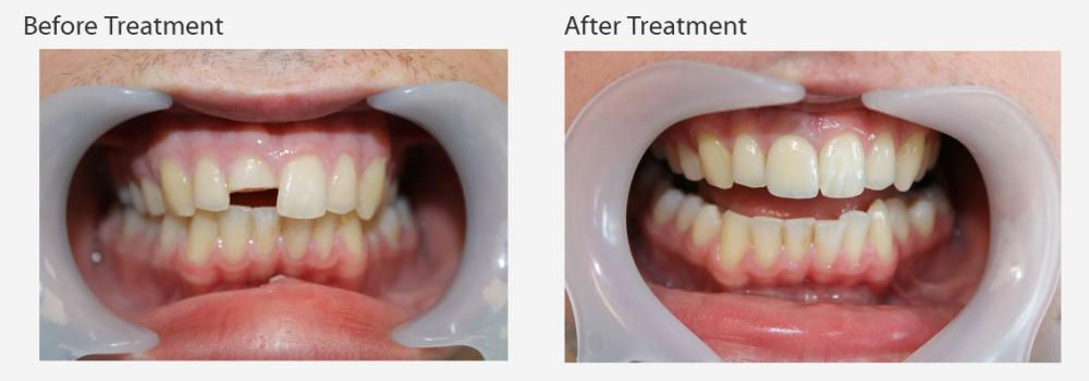 What you can expect when you need a crown!