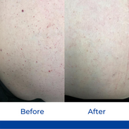 Cherry Angioma Removal | Dr. John O'Mahony's Benign Skin Lesion Clinic ...