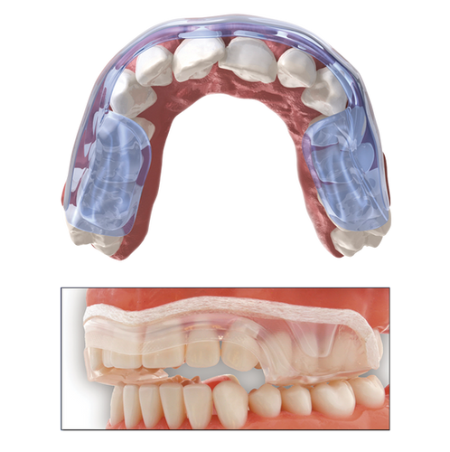AQUALIZER® Water Dental Splints - Single pack | BE Innovations
