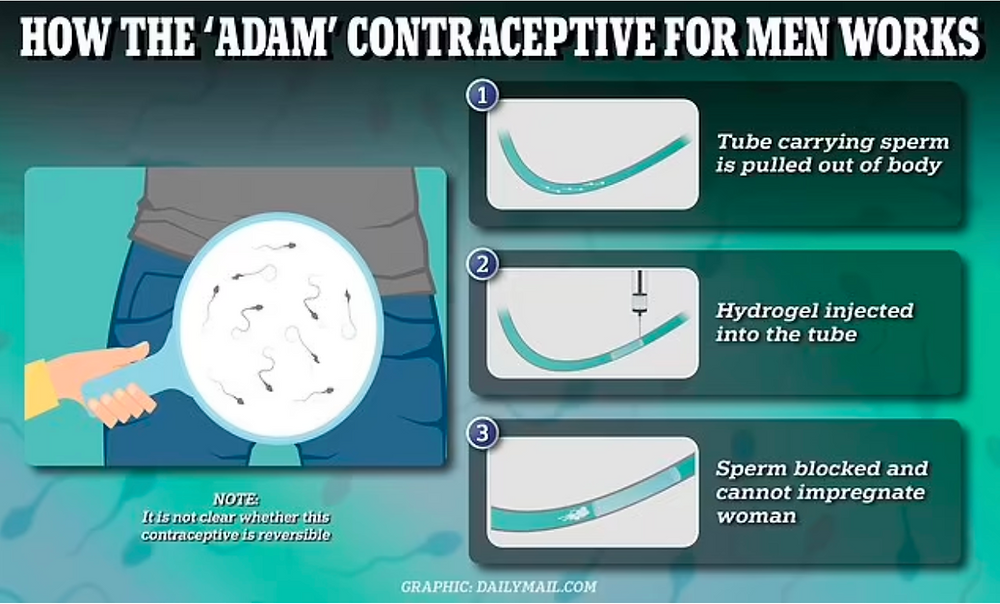 New Male IUD: ADAM