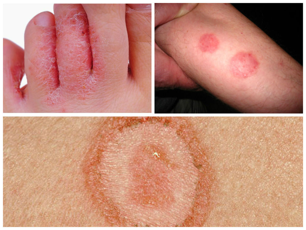 Imagens Micose De Pele - RETOEDU