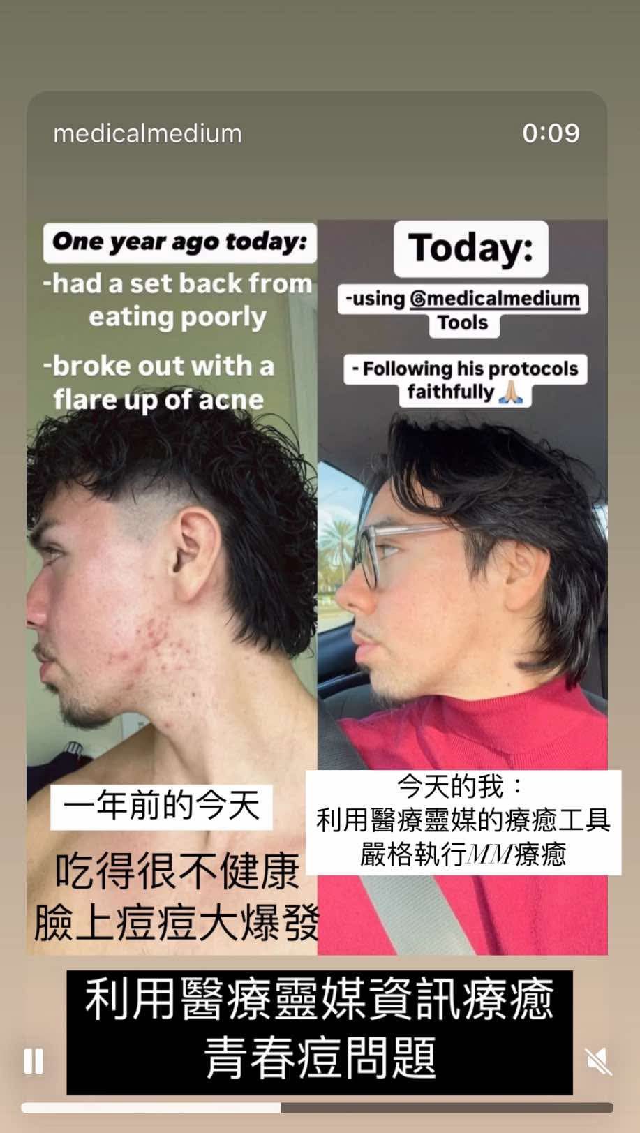 青春痘療癒實例
